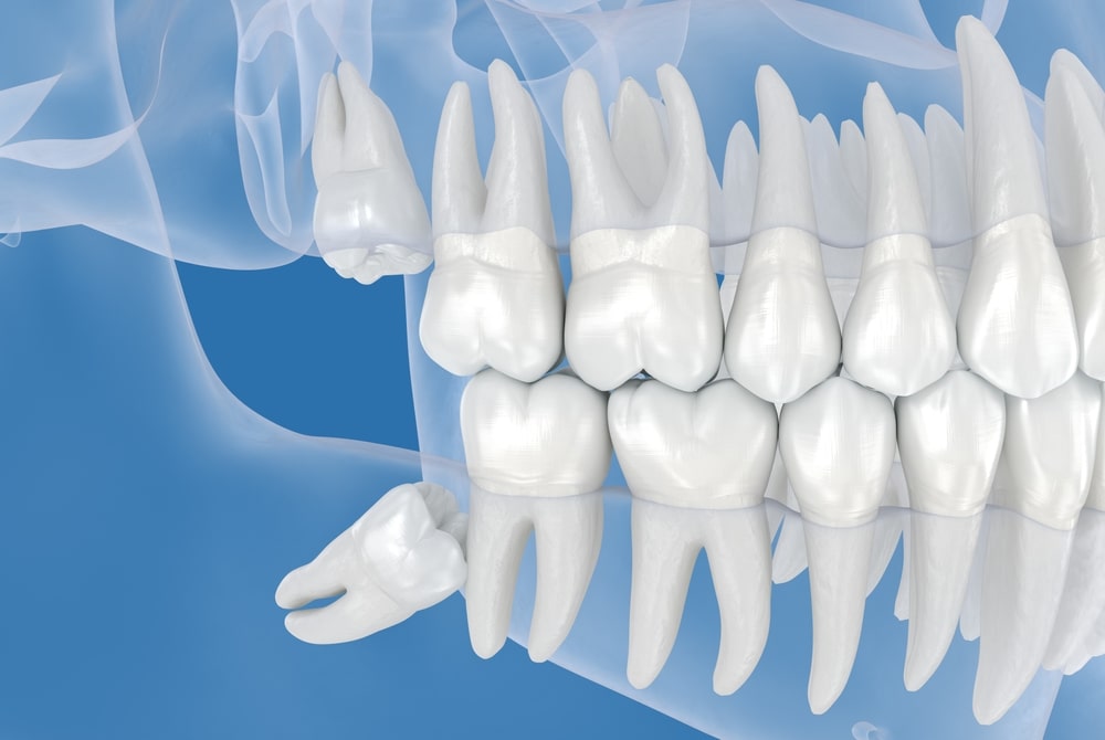 Mythes et réalités au sujet des dents de sagesse | Centre Dentaire Anjou