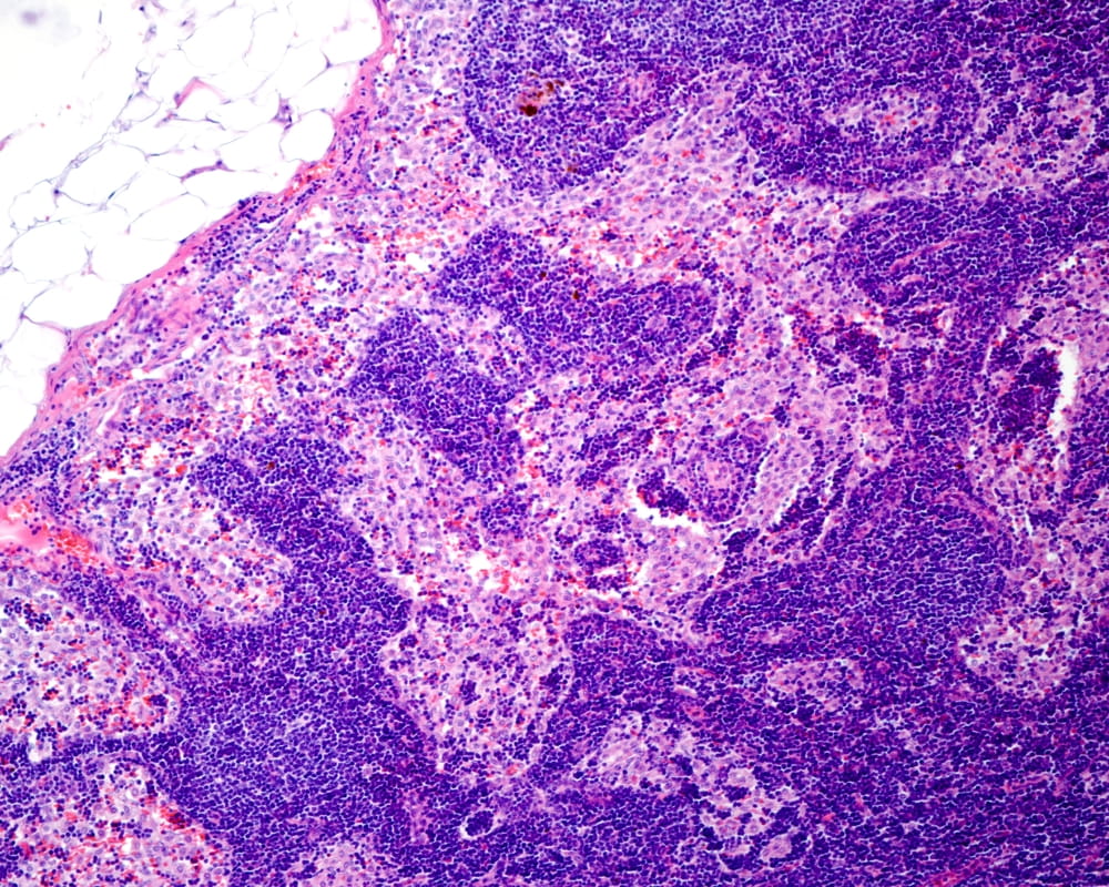 Lésions buccales : quel est le rôle de la chirurgie et de la biopsie en ...